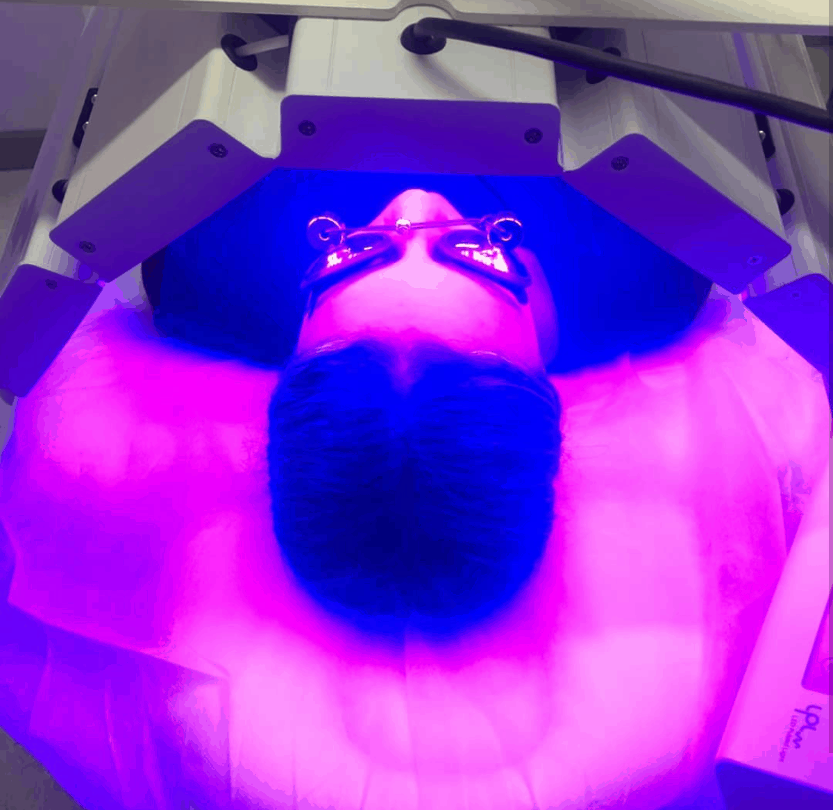 Micro-Needling Perth - DermCosmesis Laser & Aesthetics