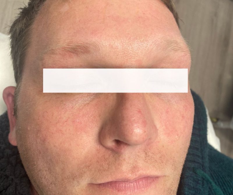 IPL Treatment in Ballajura Perth - DermCosmesis